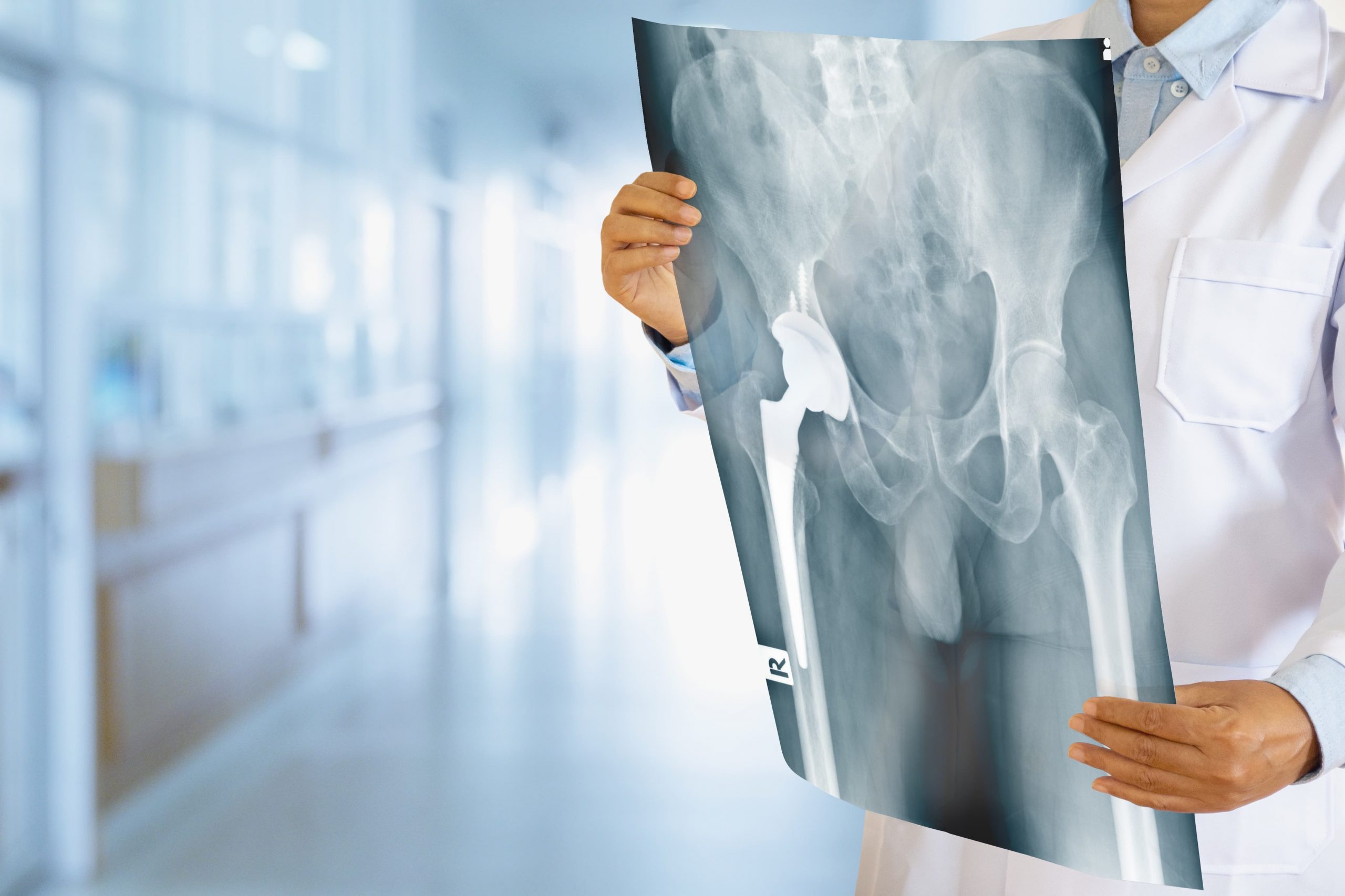 Metal Hip Replacement Injury Lawsuits | Mass Tort Alliance